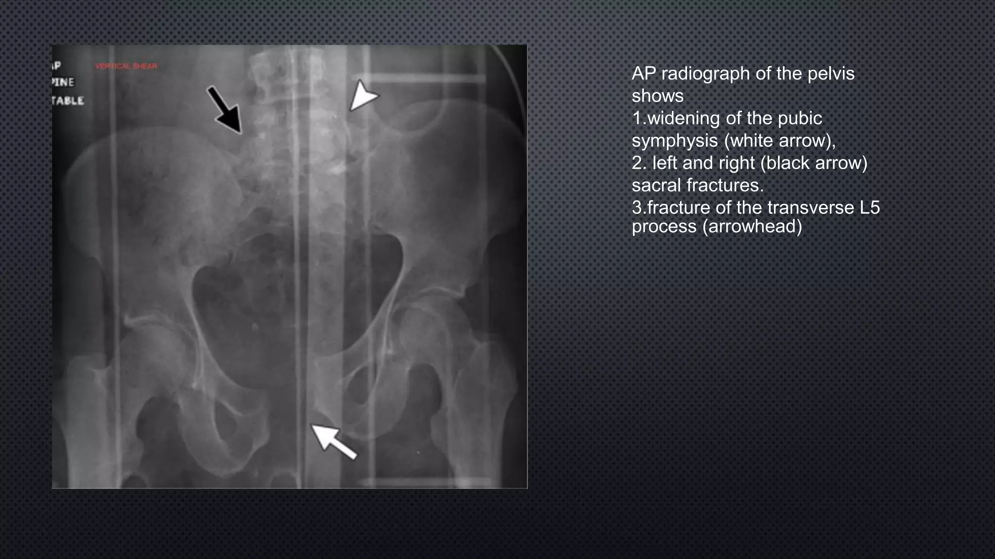 Pelvis fractures | PPTX