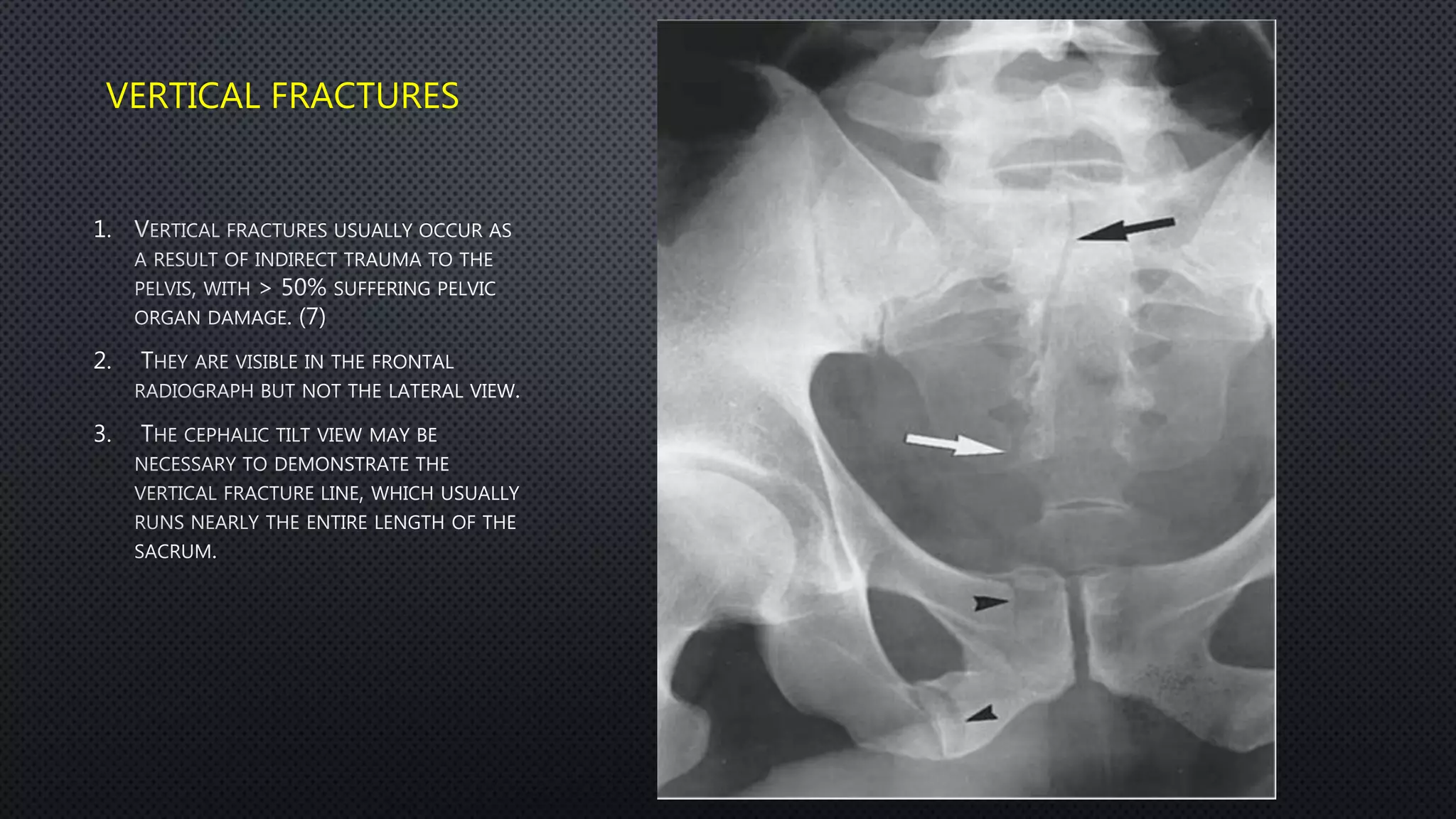 Pelvis fractures | PPTX