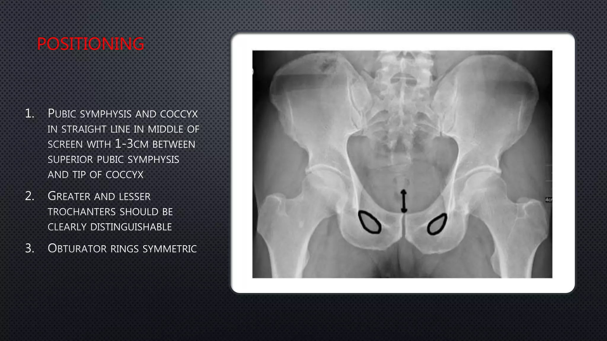 Pelvis fractures | PPT