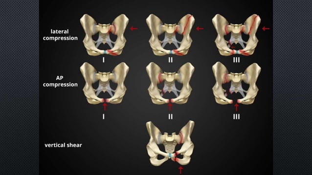 Pelvis fractures | PPT