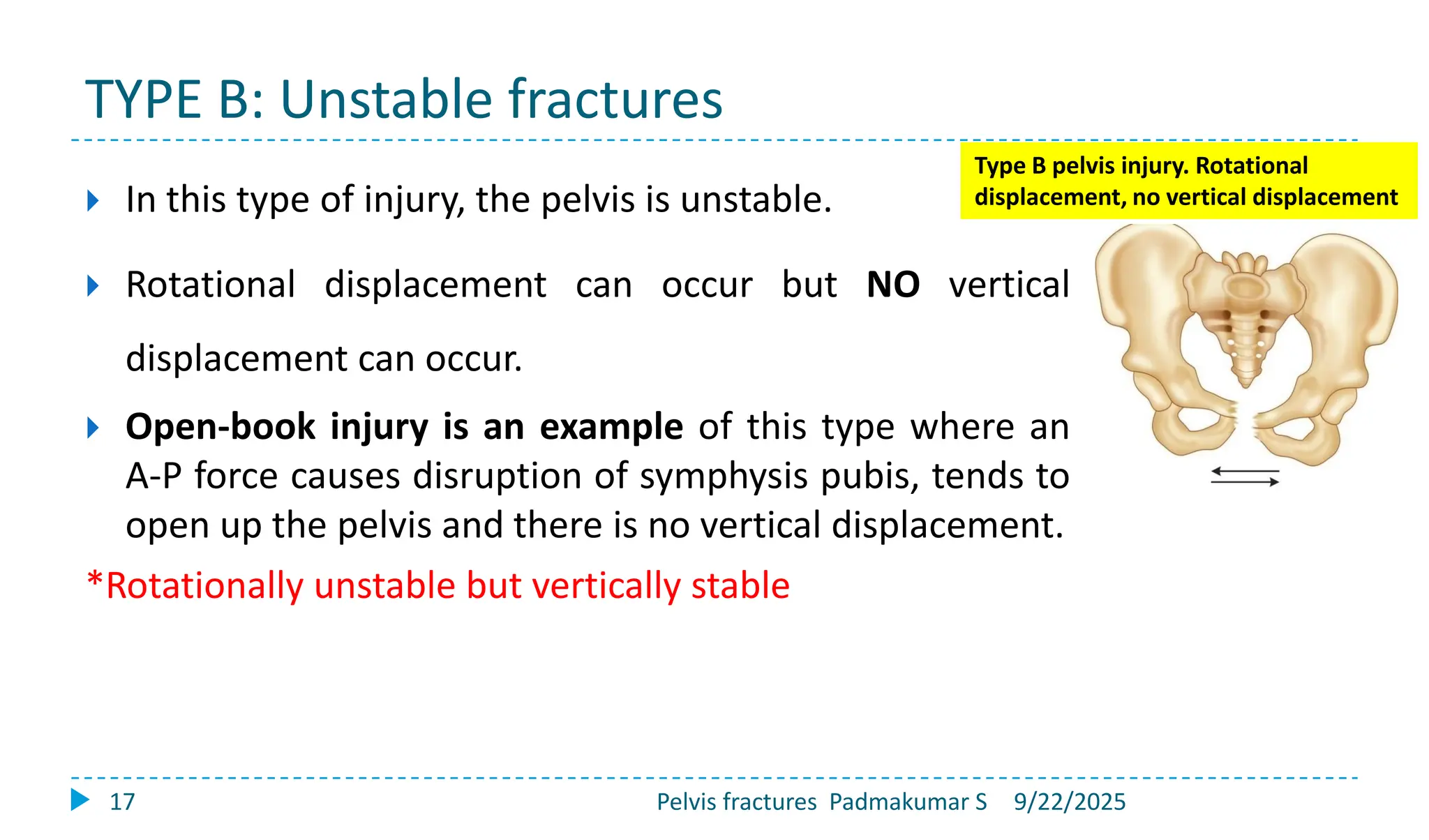 Pelvis fractures-types ,Clinical features and management | PDF
