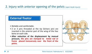 Pelvis fractures-types ,Clinical features and management | PDF