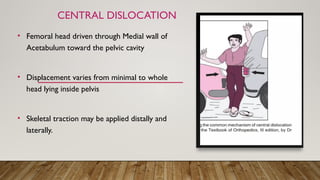 PELVIS FRACTURES AND HIP DISLOCATIONS.pptx