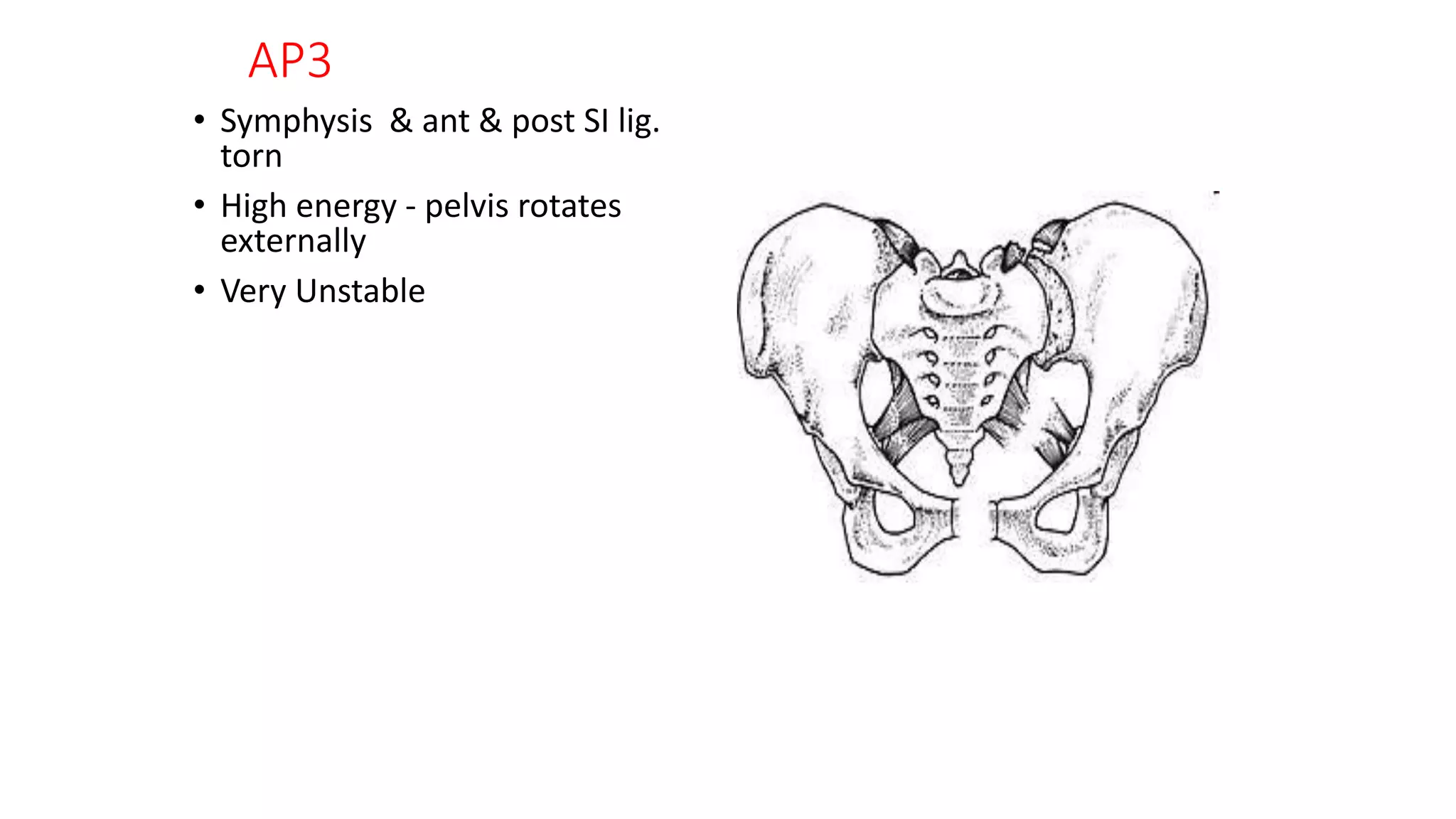 pelvis fractures corrected.pptx