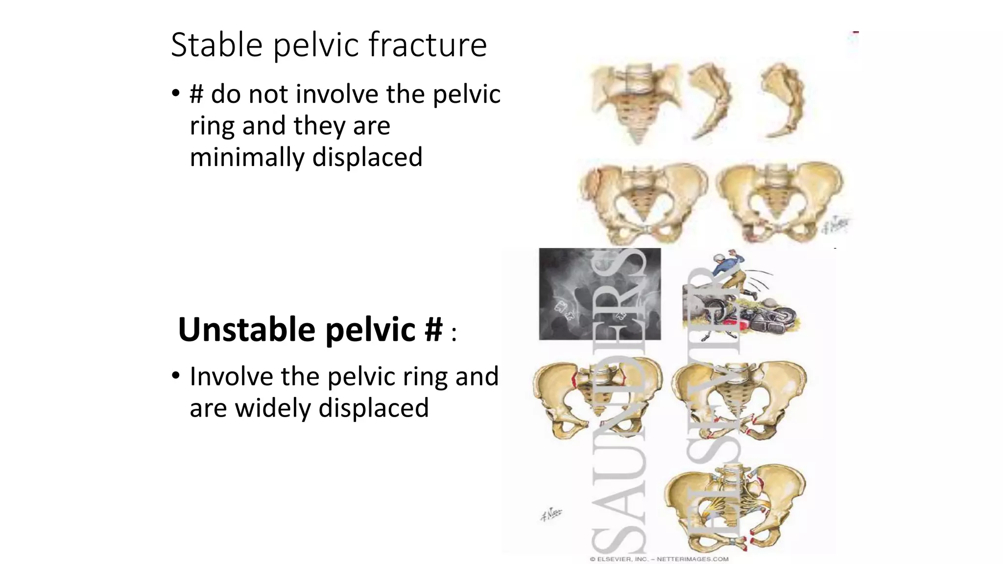 pelvis fractures corrected.pptx