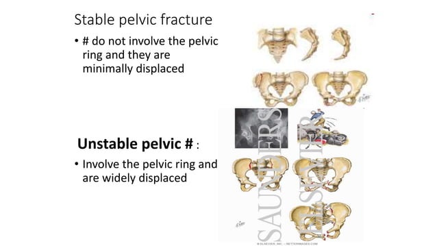 pelvis fractures corrected.pptx