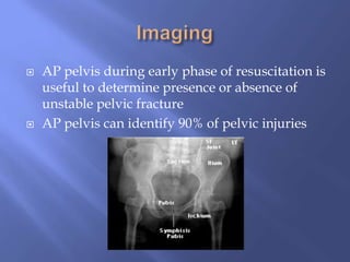 Pelvic fracture | PPTX