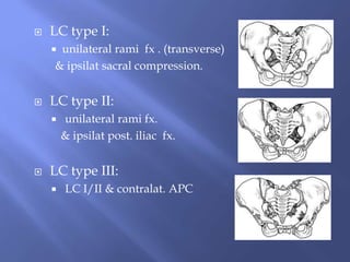 Pelvic fracture | PPT