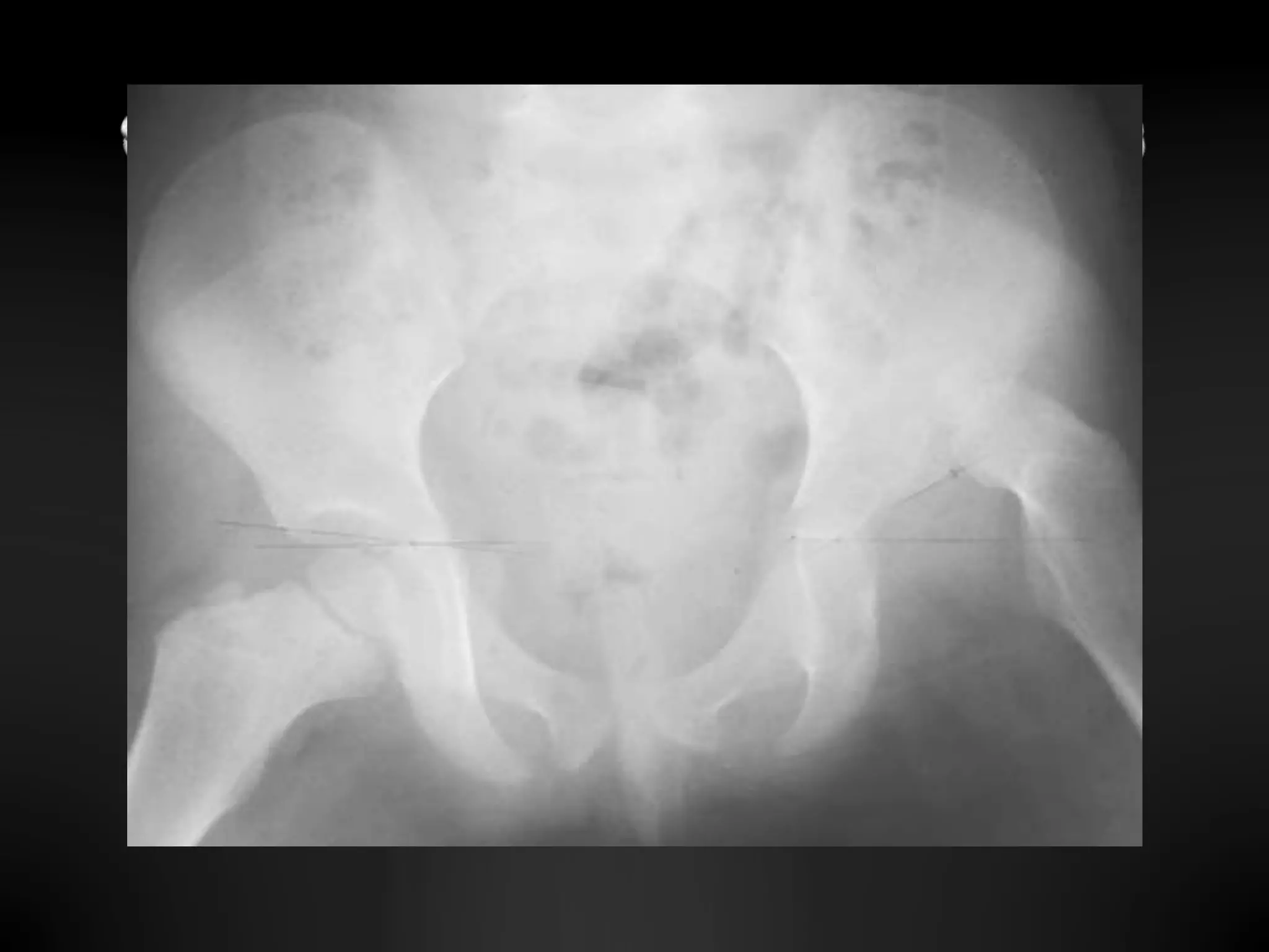 Pelvis osteotomies in ddh patients | PPTX