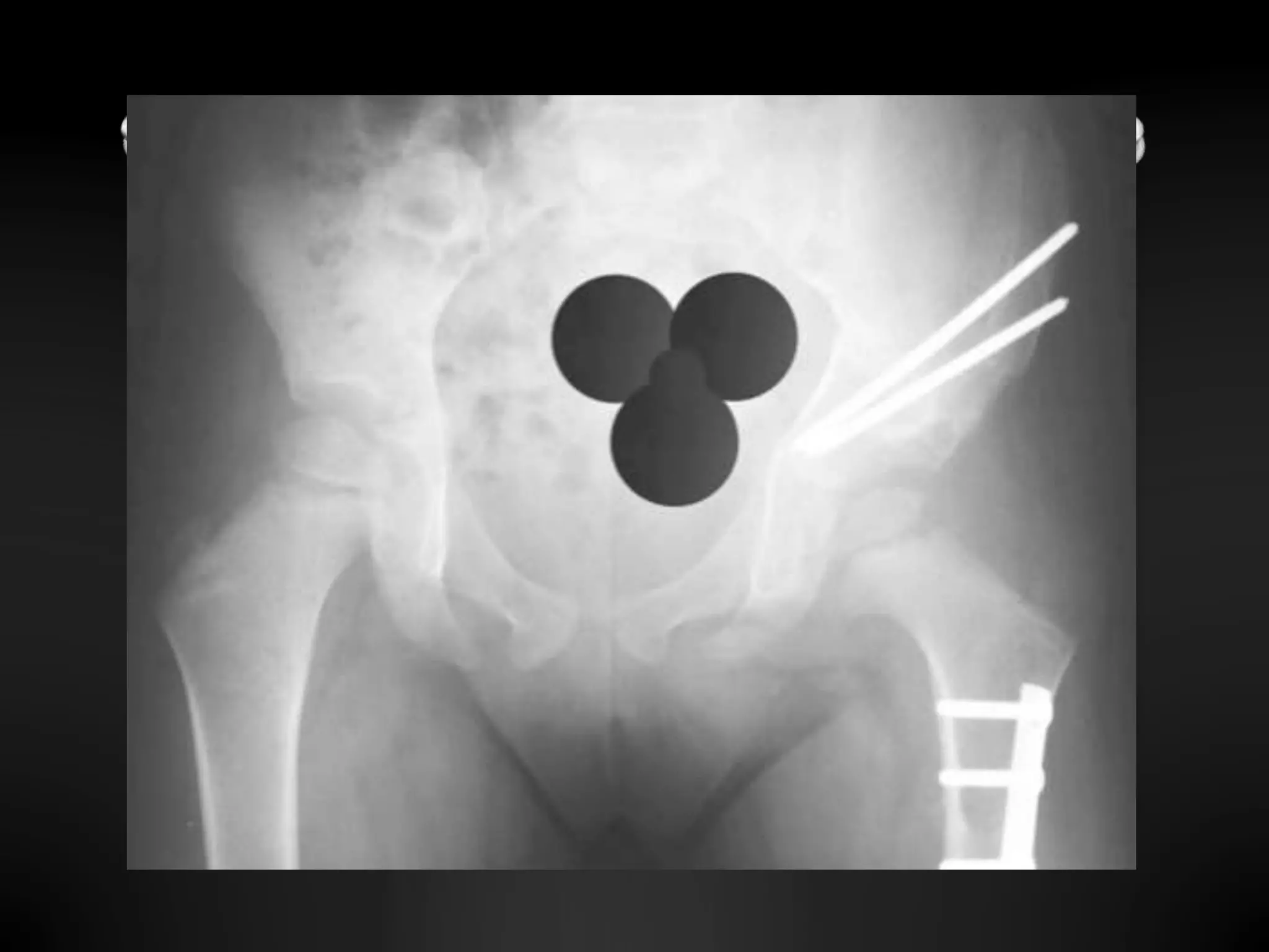 Pelvis osteotomies in ddh patients | PPTX