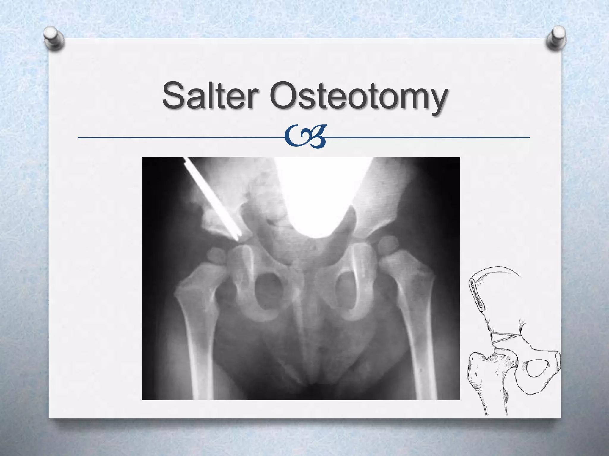 Pelvis osteotomies in ddh patients | PPTX