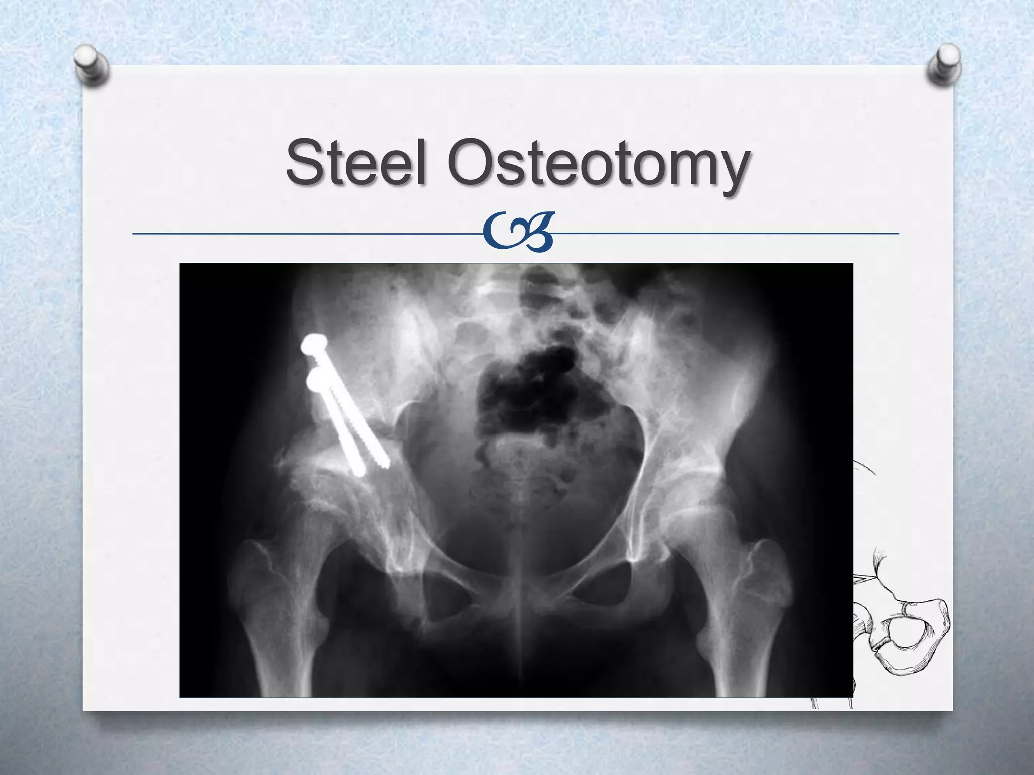 Pelvis osteotomies in ddh patients | PPTX