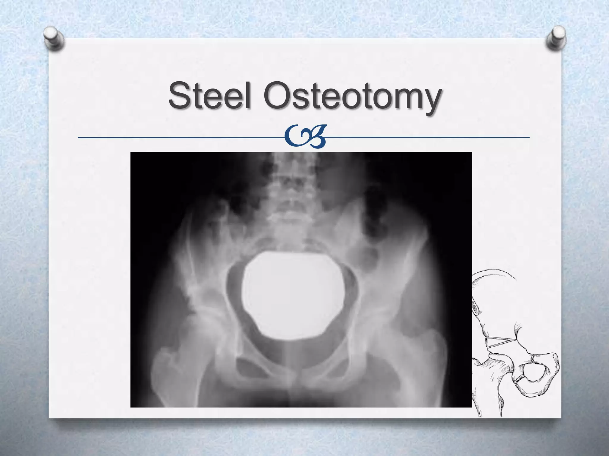 Pelvis osteotomies in ddh patients | PPTX