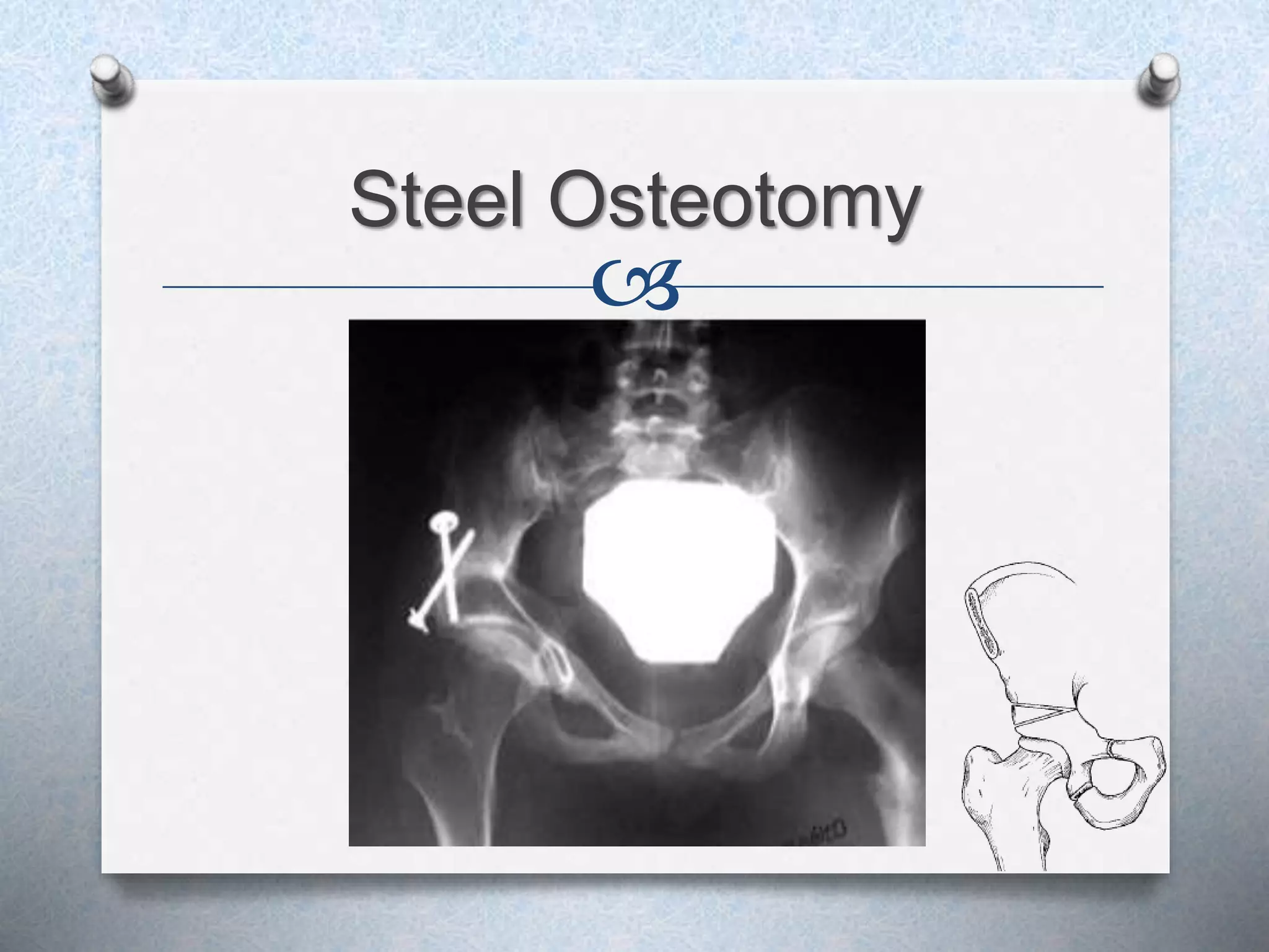 Pelvis osteotomies in ddh patients | PPTX