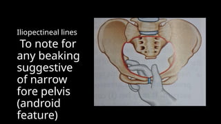 pelvis types (1).pptx[ASHISH) obs seminar | PPTX
