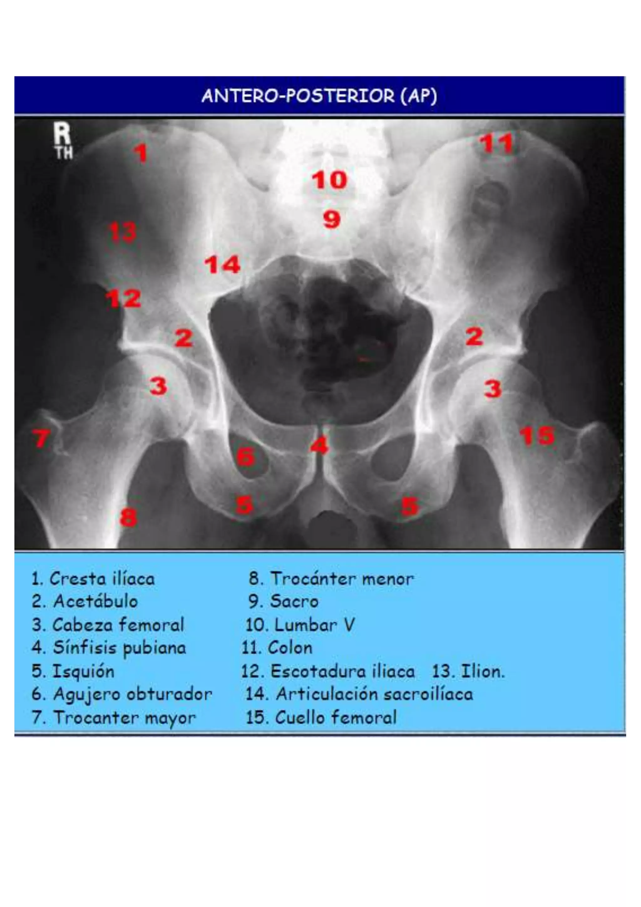 Pelvis y cadera con sus partes señaladas | PDF