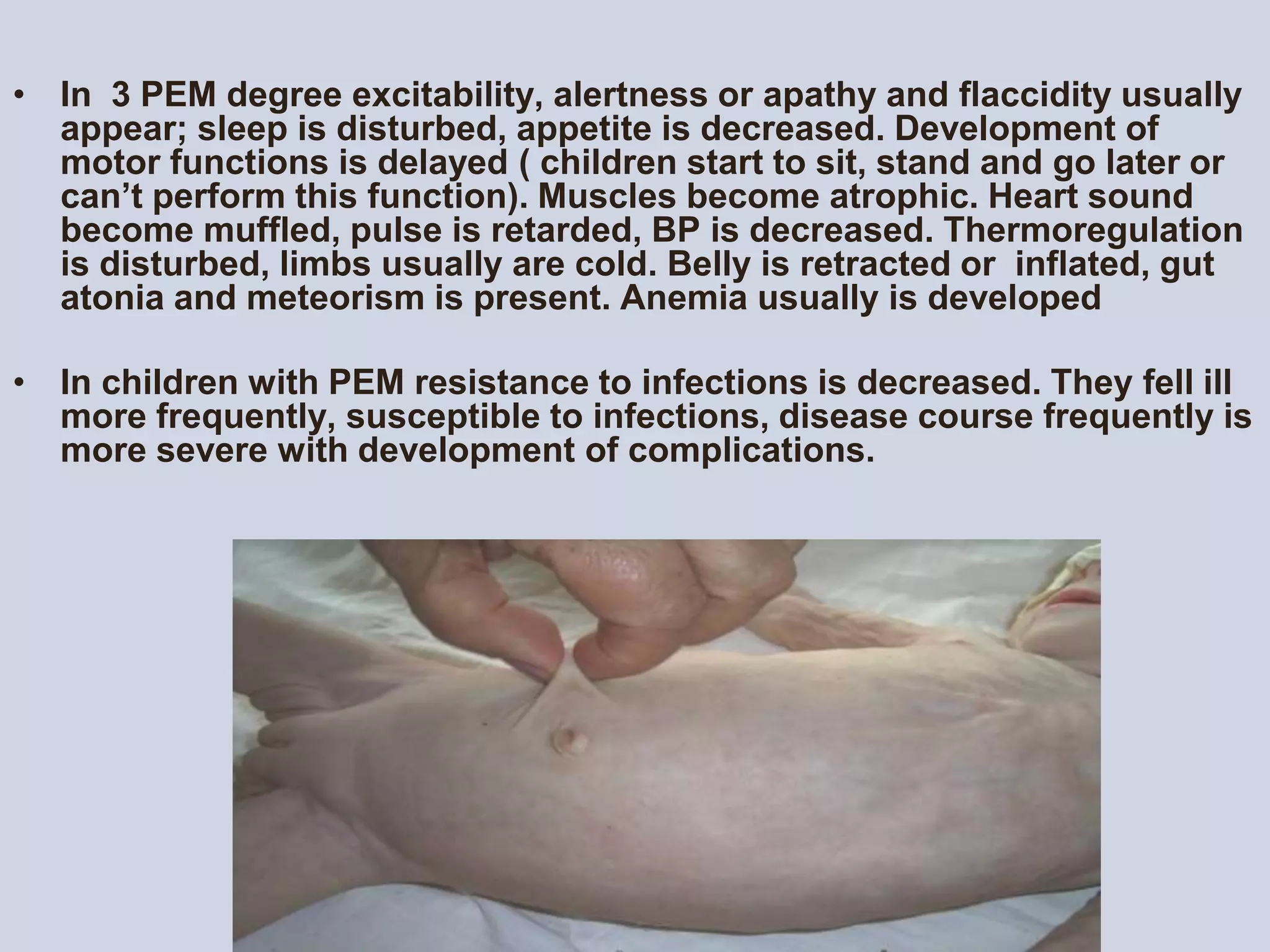 Protein energy malnutrition in children | PPT