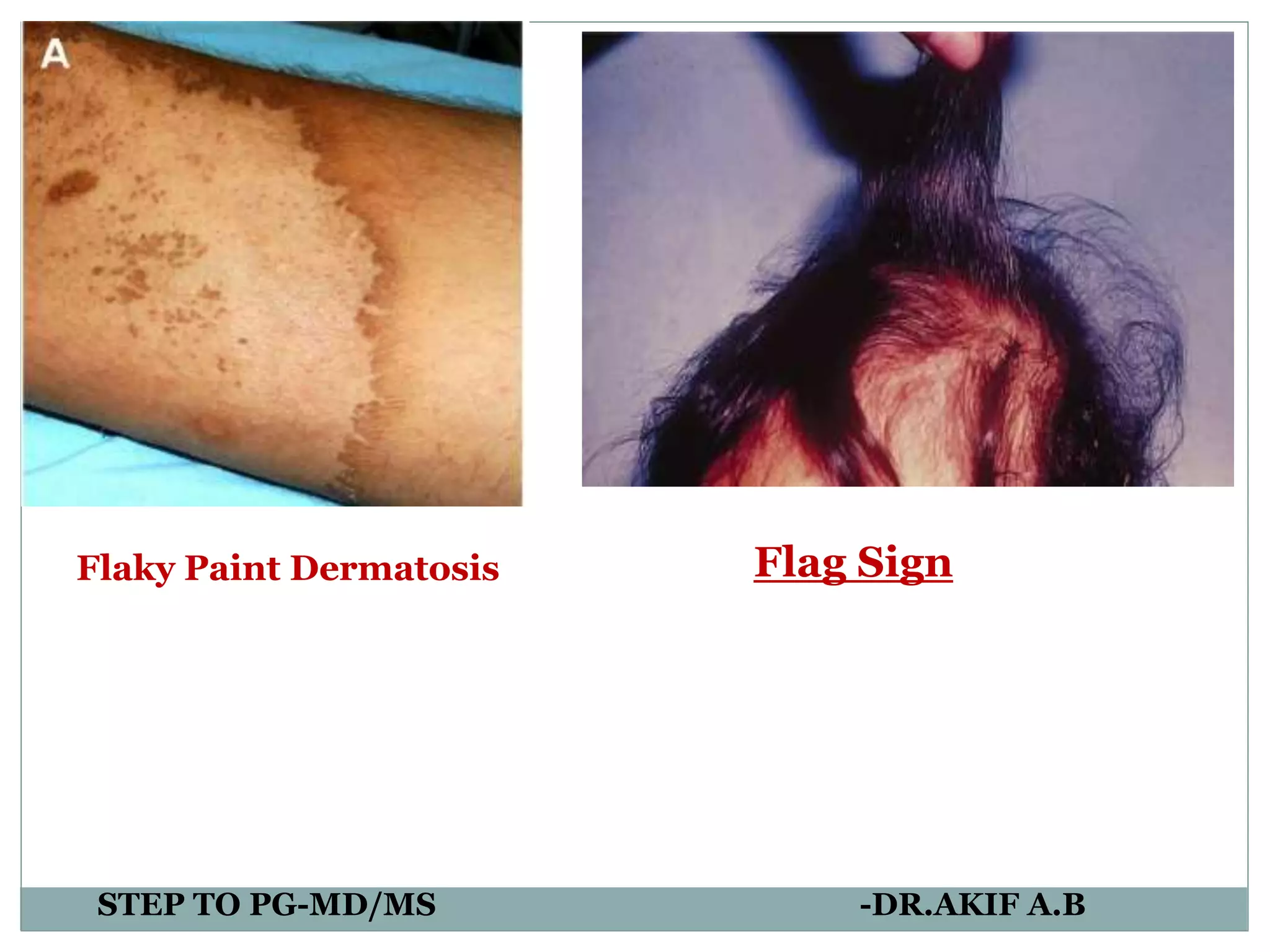 PROTEIN ENERGY MALNUTRITION | PPTX