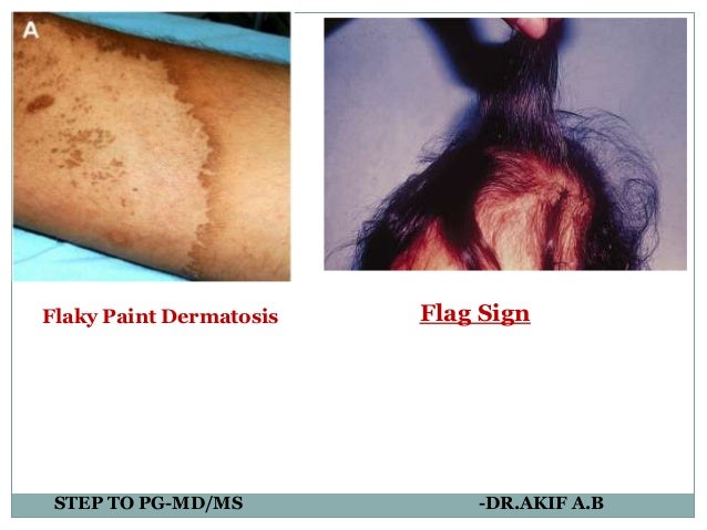 PROTEIN ENERGY MALNUTRITION