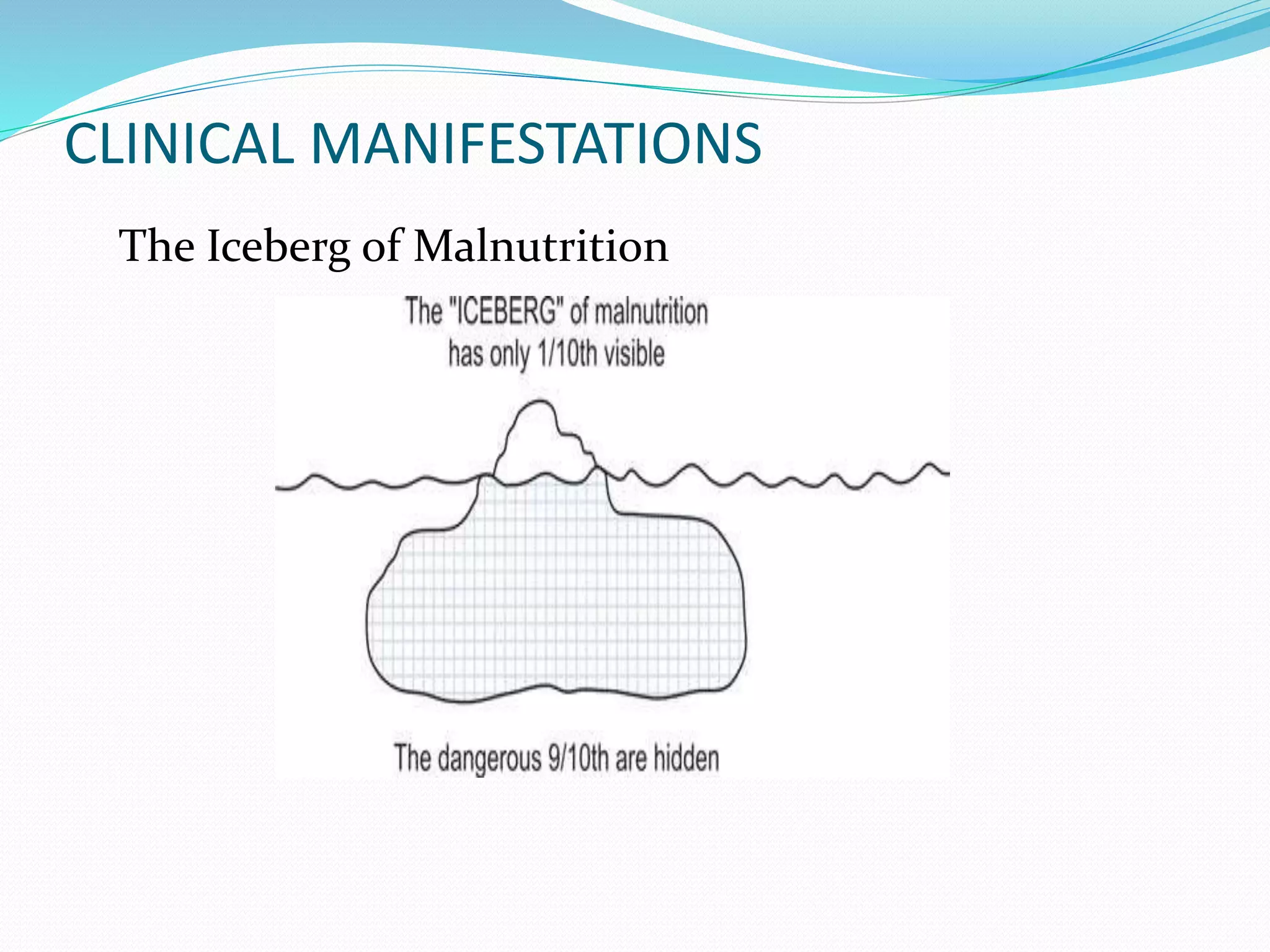 protein energy malnutrition | PPTX