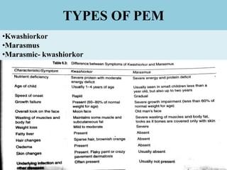 Protein Energy Malnutrition | PPTX