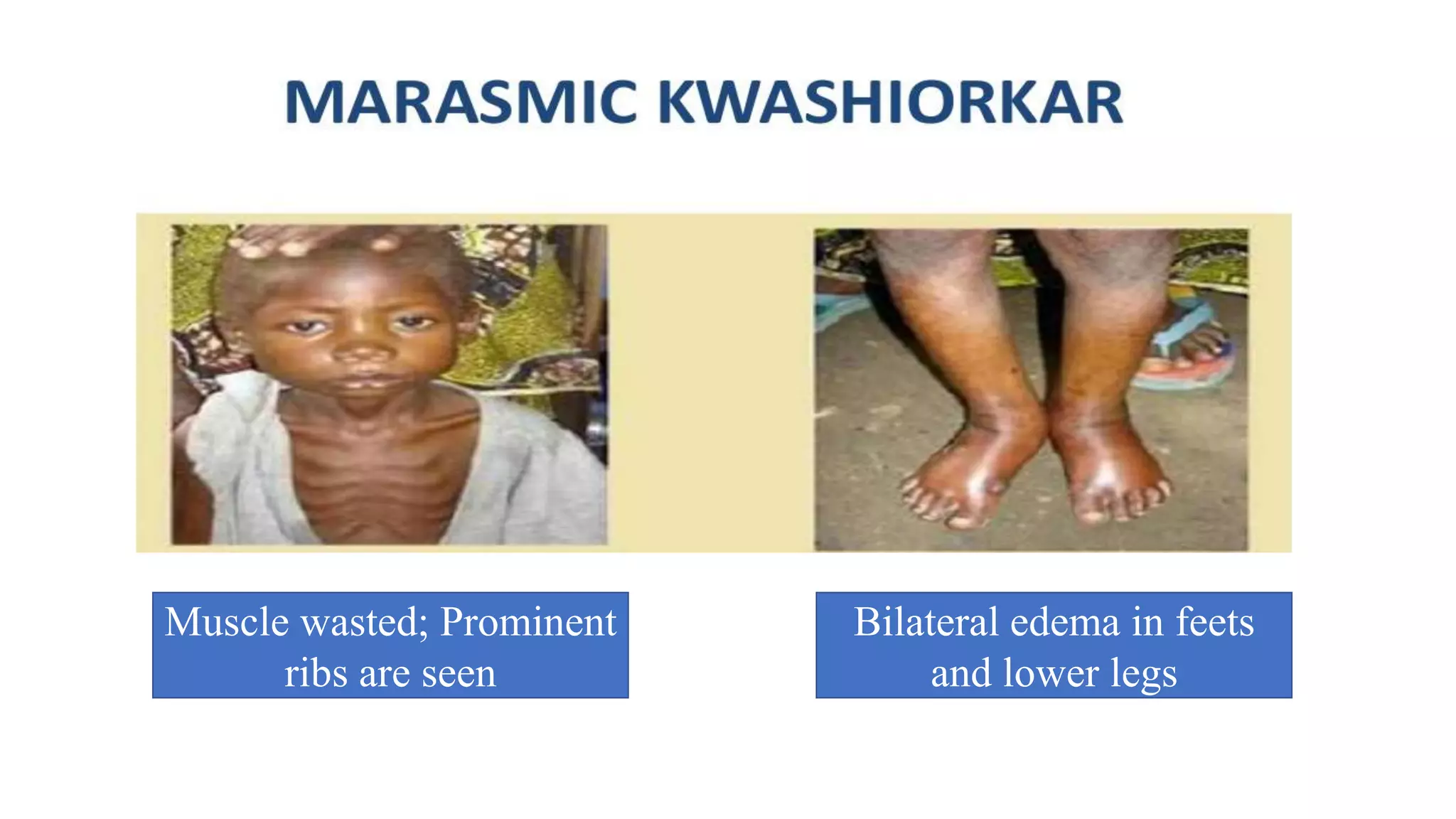 Protein Energy Malnutrition (PEM) | PPTX