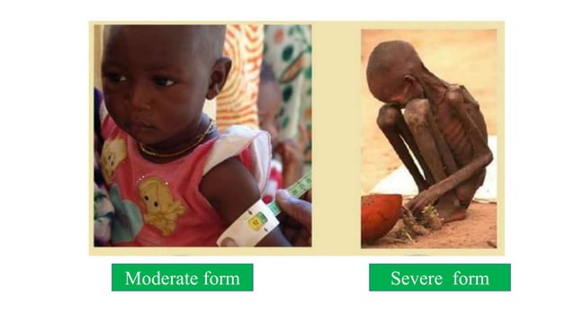 Protein Energy Malnutrition (PEM) | PPTX | Nutrition | Healthy Living