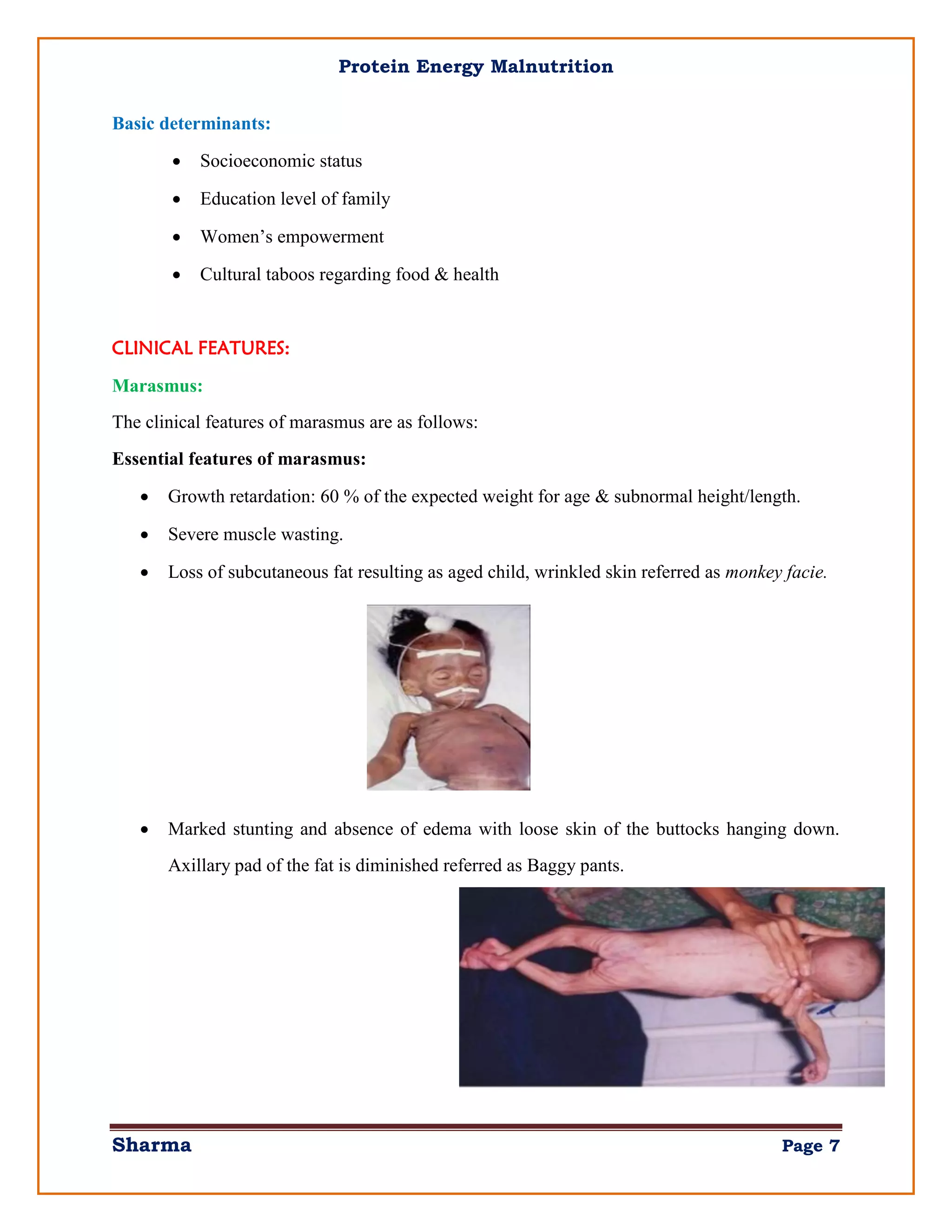 Protein Energy Malnutrition | PDF