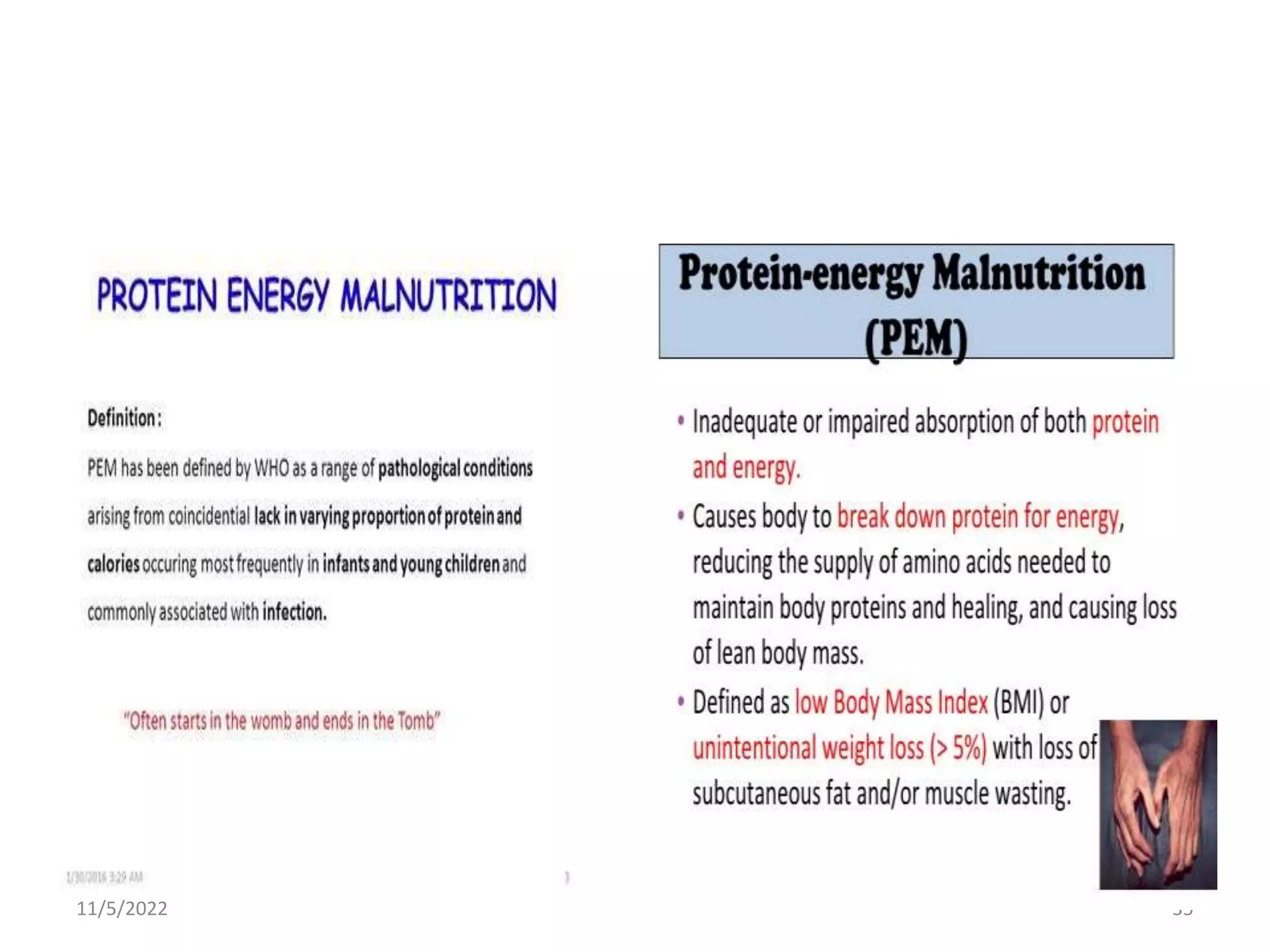 Balanced diet snd PEM management.pptx