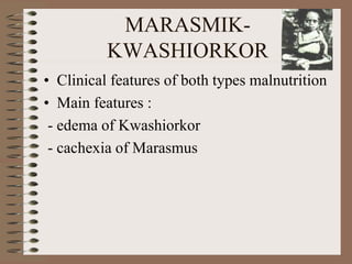 Protein energy Malnutrition | PPT