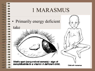 Protein energy Malnutrition | PPT