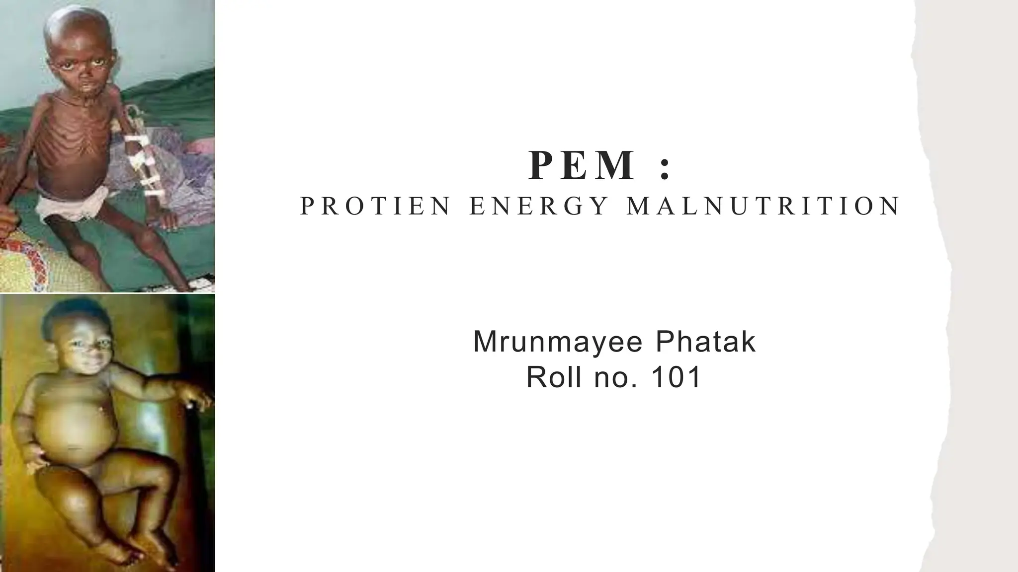 PROTIEN ENERGY MALNUTRITION FOR UNDERGRADUATE STUDENTS | PPTX