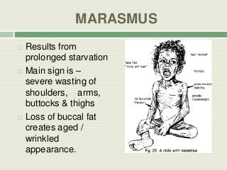 Protein Energy Malnutrition | PPTX