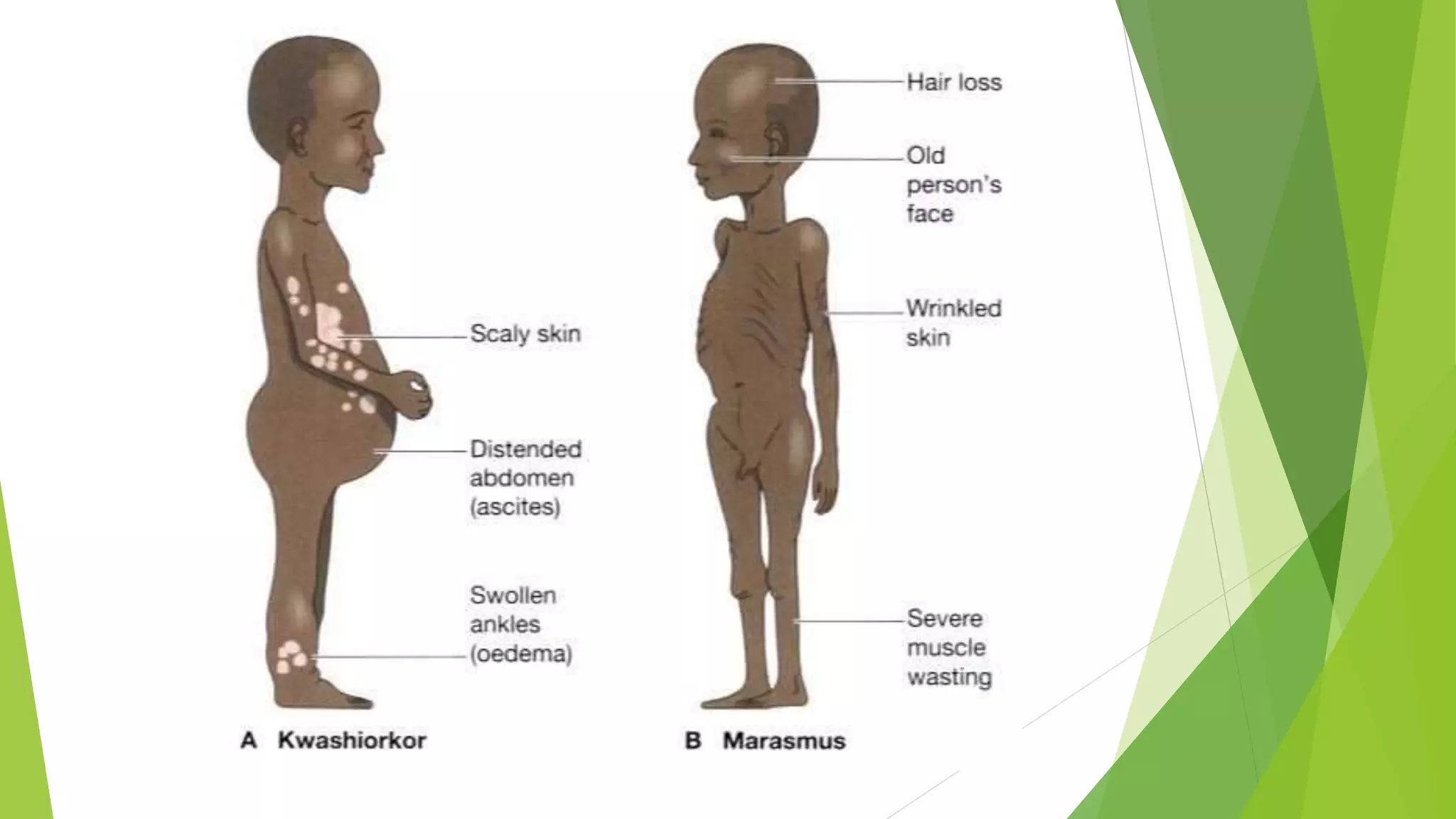 Protean energy malnutrition (PEM) Child Health Nursing.pptx