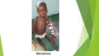 Protean energy malnutrition (PEM) Child Health Nursing.pptx