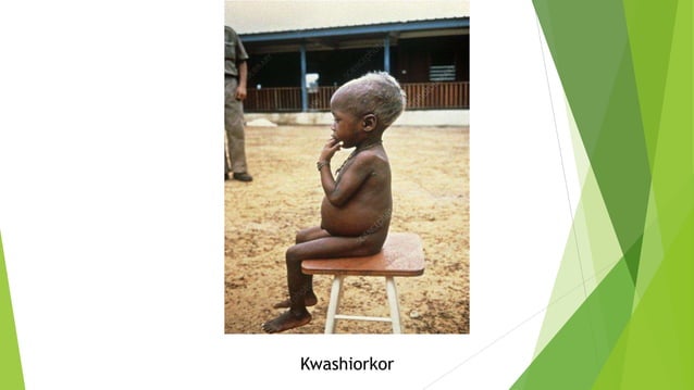 Protean energy malnutrition (PEM) Child Health Nursing.pptx | Nutrition ...