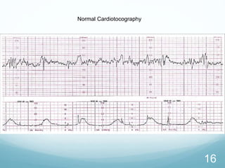 Pemantauan Kesejahteraan Janin,pemeriksaan, p | PPTX