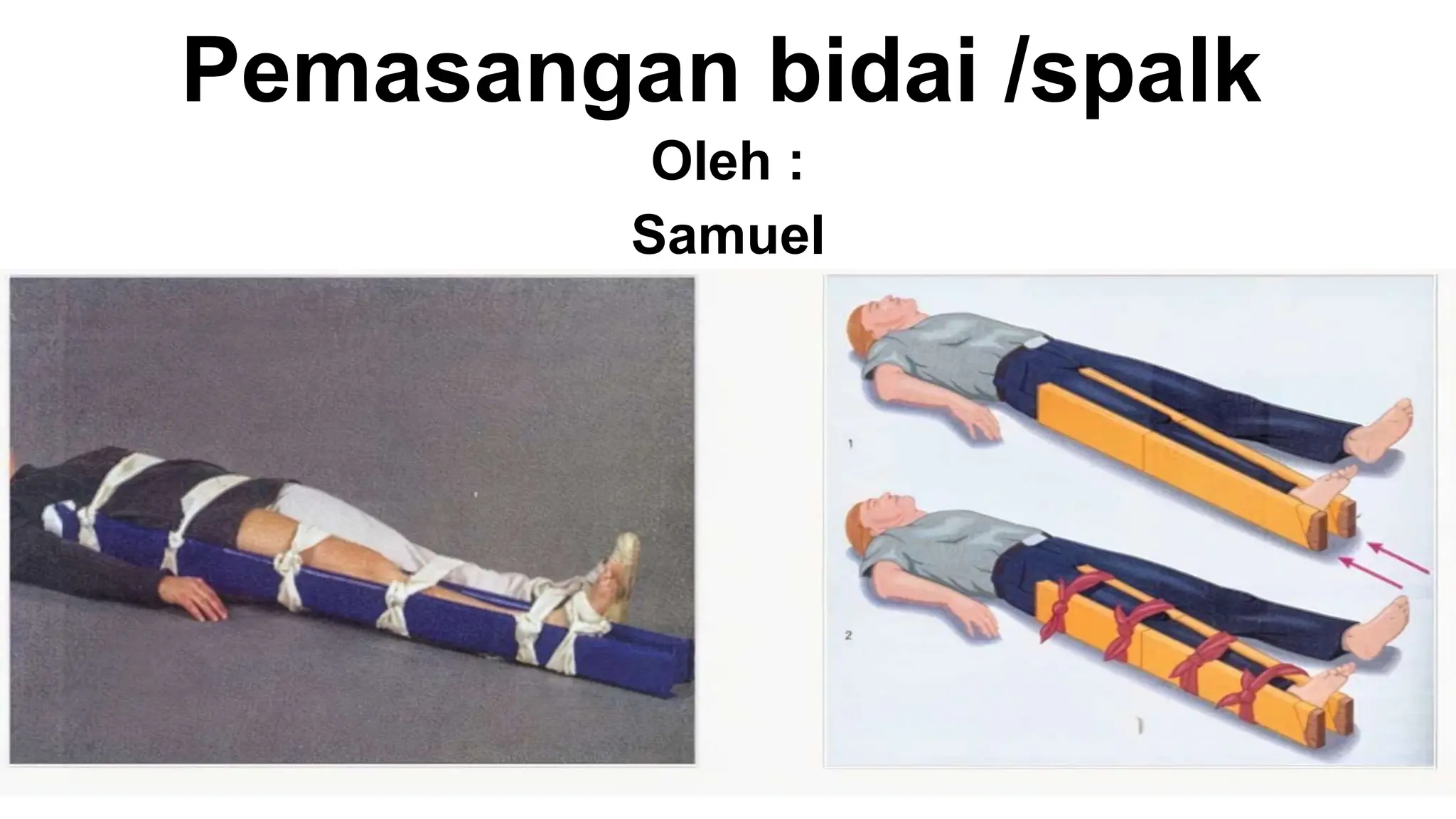 Pemasangan bidai spalk samuel yang sangat luarbiasa hebat dan susah.pptx