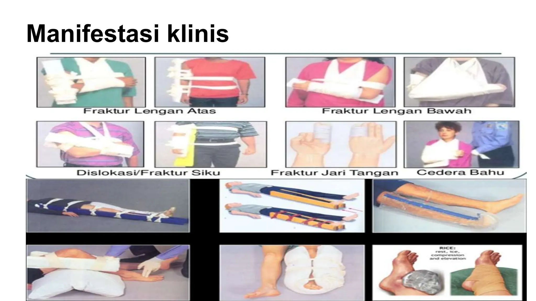 Pemasangan bidai spalk samuel yang sangat luarbiasa hebat dan susah.pptx