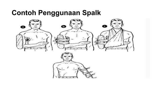 Pemasangan bidai spalk samuel yang sangat luarbiasa hebat dan susah.pptx