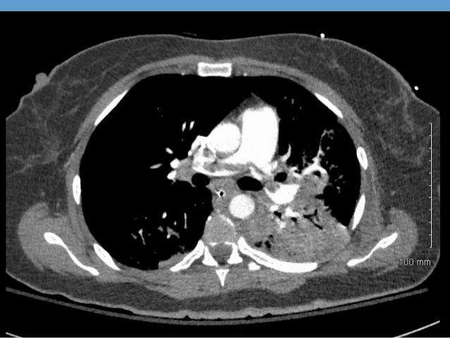 Normal Lv Size With Hyperdynamic Systolic Function | Paul Smith