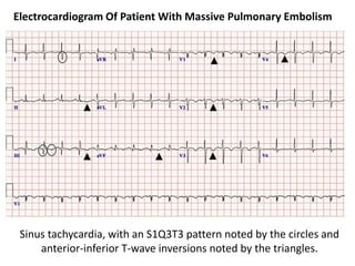 Update on Pulmonary Embolism | PPTX