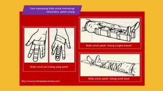 cara melakukan PEMBALUTAN DAN PEMBIDAIAN.pptx