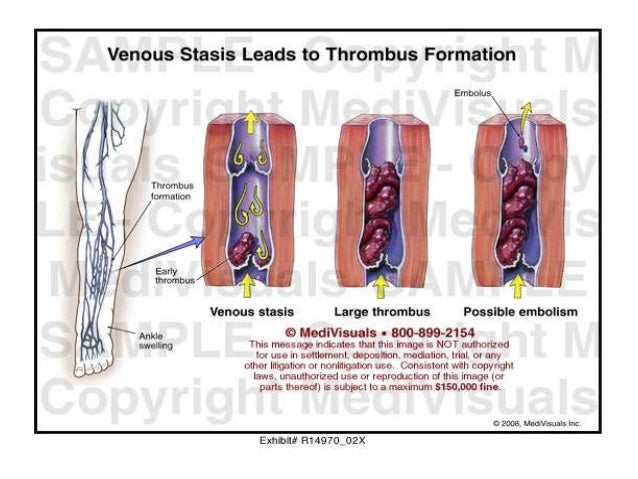 GANGGUAN PEREDARAN DARAH PERIFER