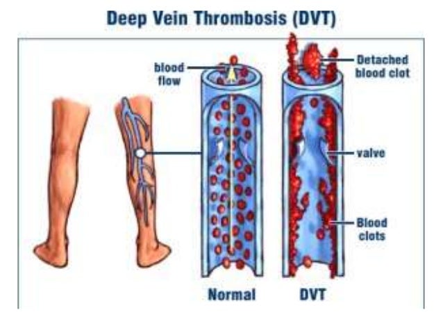 GANGGUAN PEREDARAN DARAH PERIFER