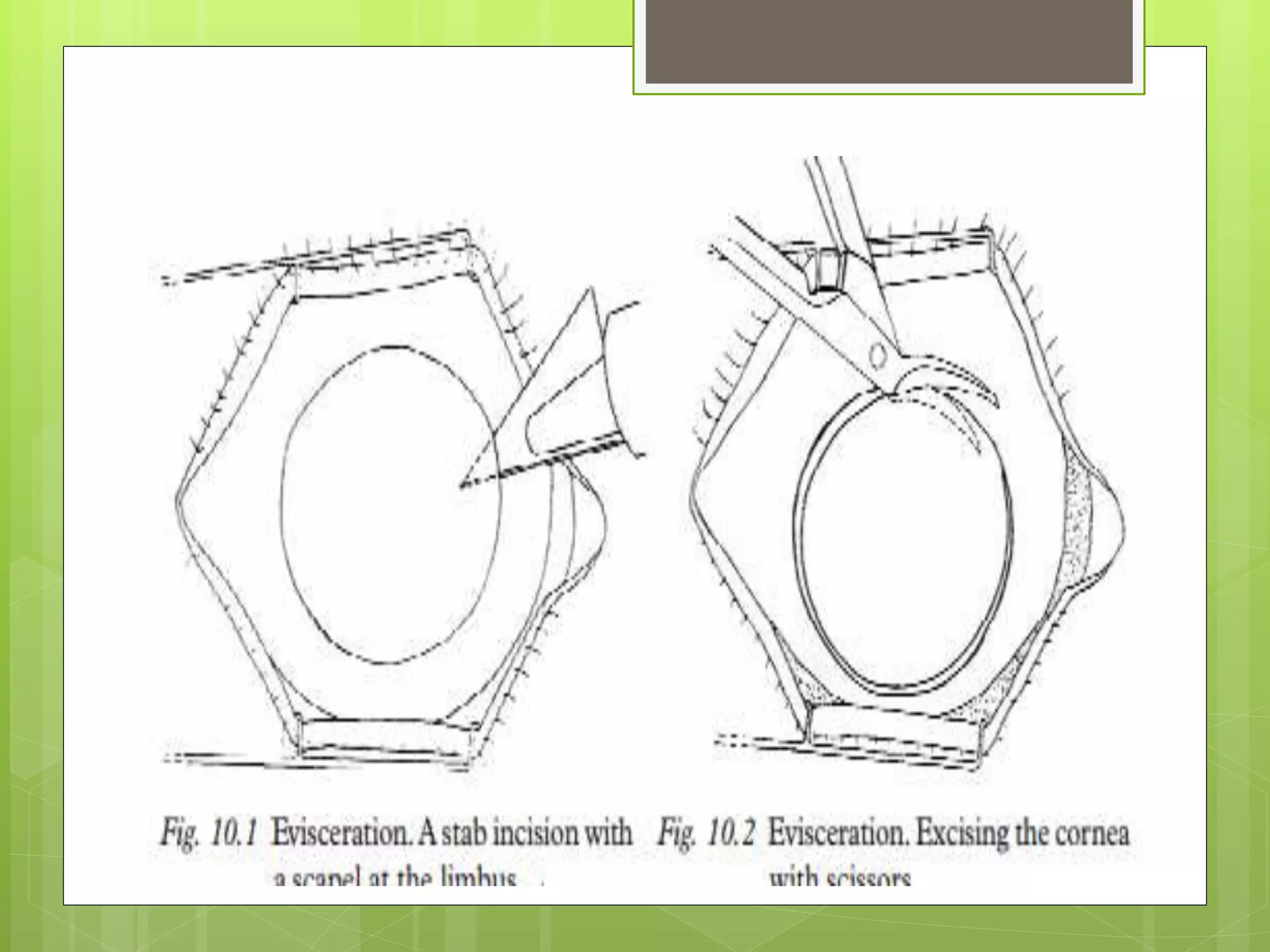 Pembedahan pada mata | PPTX