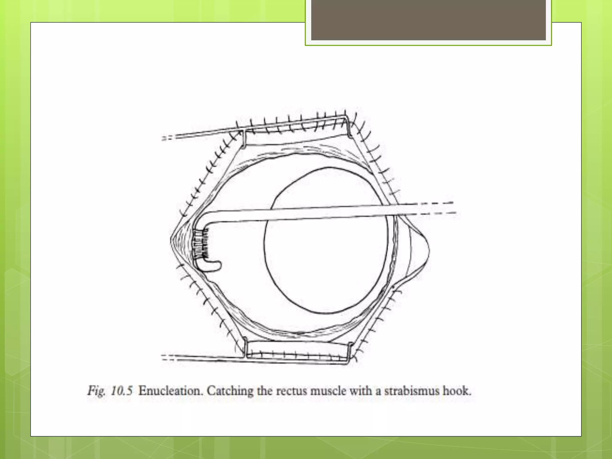 Pembedahan pada mata | PPTX