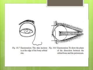 Pembedahan pada mata | PPTX