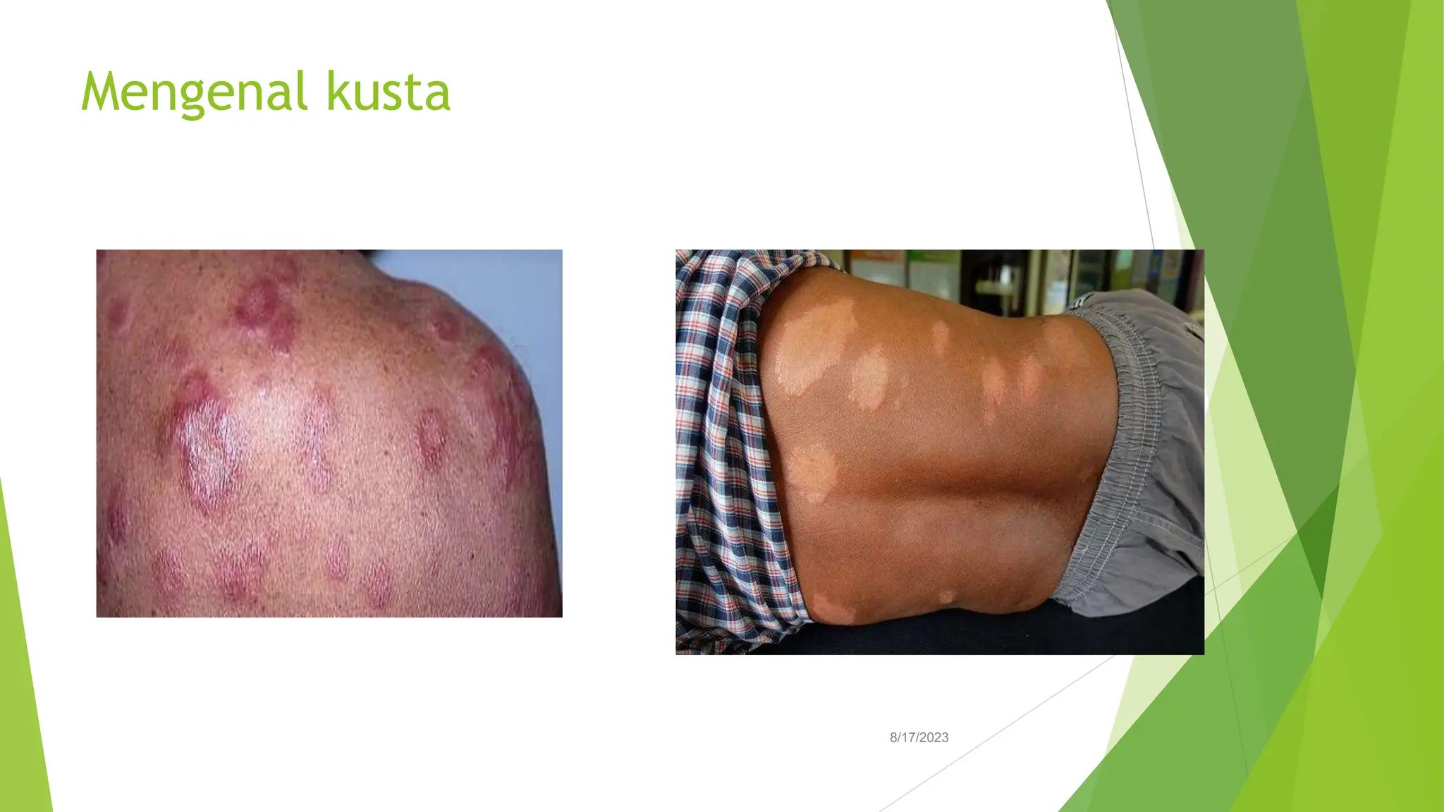 pemberdayaankadermalaria-tb-dan-kusta-.pptx