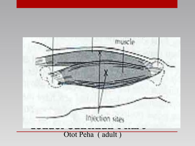 Pemberian Ubat Parenteral - Suntikan | PPT
